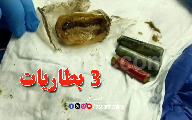 في عملية نادرة.. إخراج 3 بطاريات من معدة مريض بقيت داخل جسده لأكثر من عام – Assarih